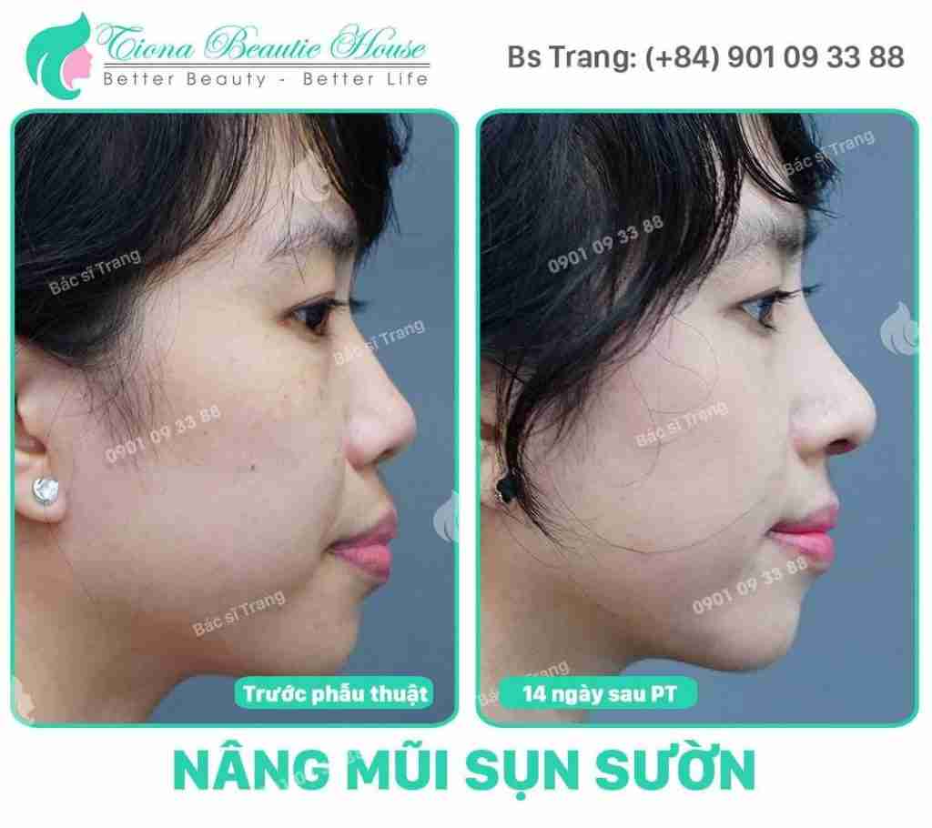 Sửa mũi có đau không? “GÂY TÊ ĐA TẦNG" by Dr Trang TARA