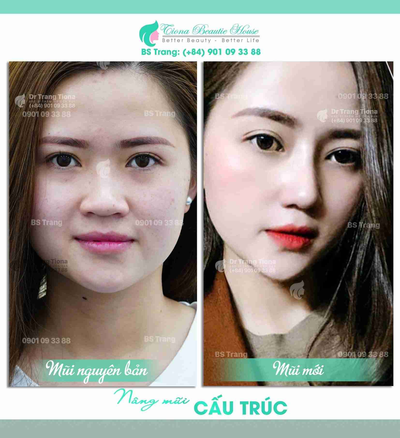 7 bí quyết để nâng mũi cấu trúc Surgiform bền, đẹp tự nhiên