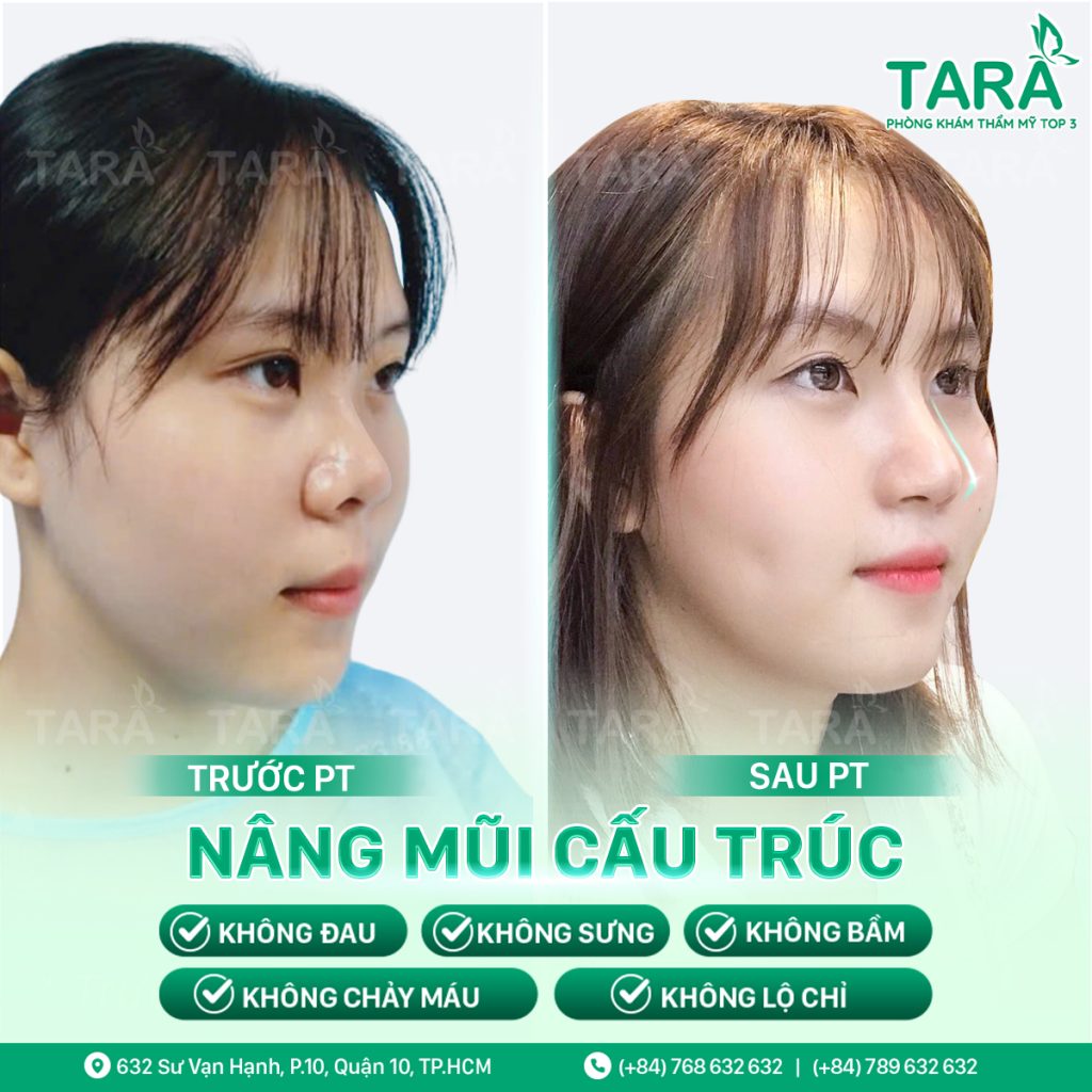 Bác sĩ nâng mũi đẹp uy tín tại TPHCM - Dr Trang TARA