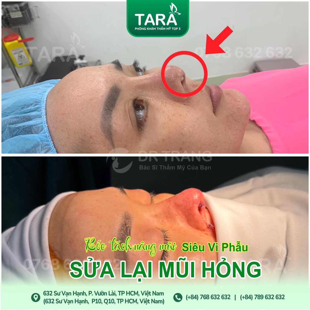 Địa chỉ sửa mũi hỏng siêu vi phẫu bằng trung bì mỡ TPHCM